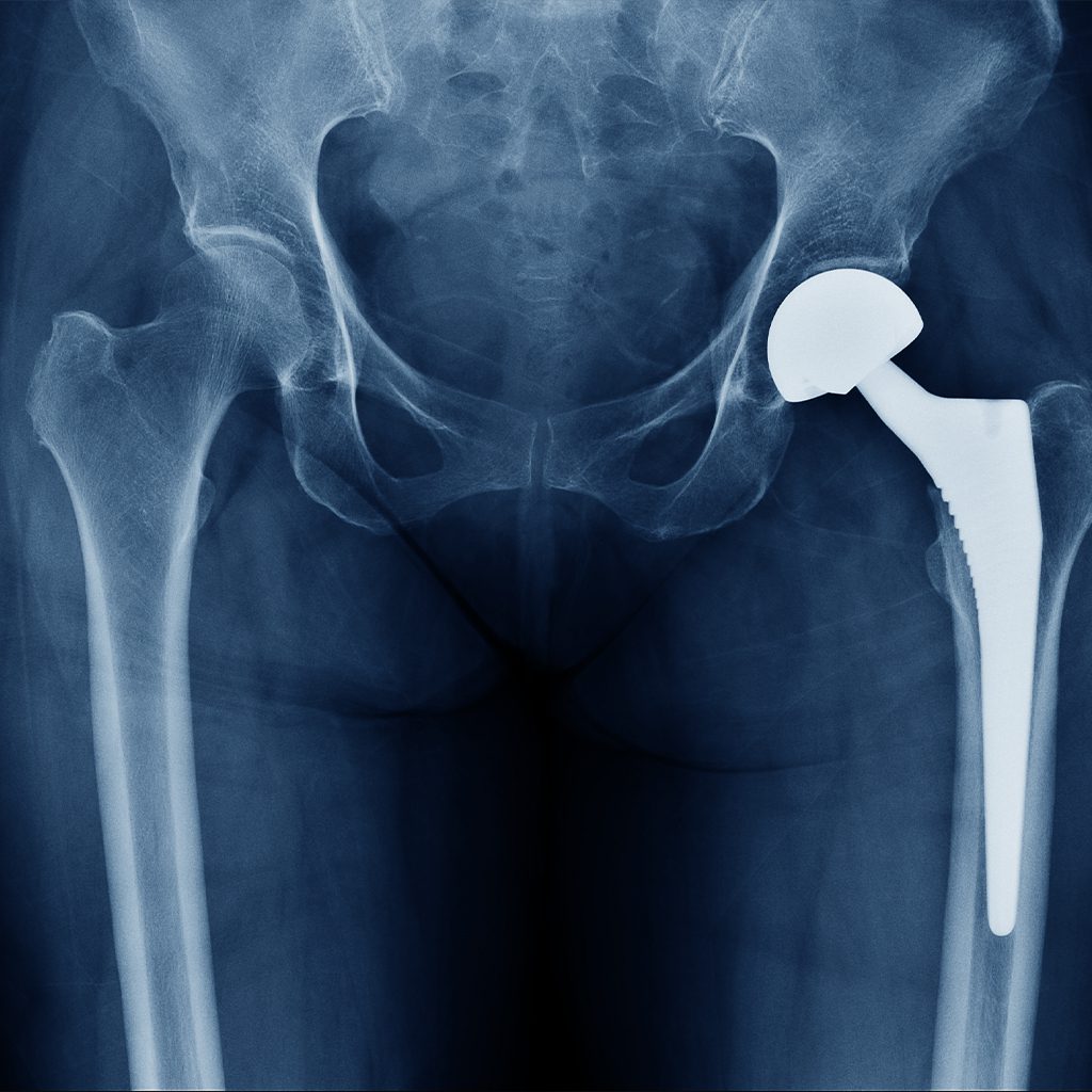 Hip Replacement Surgery - HealthScope® Magazine