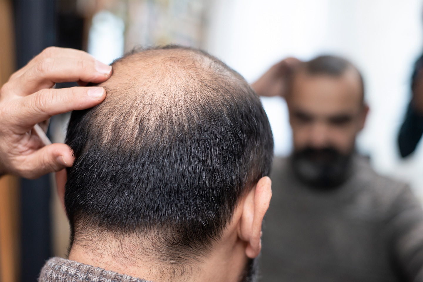 Embracing Male Pattern Baldness - HealthScope® Magazine
