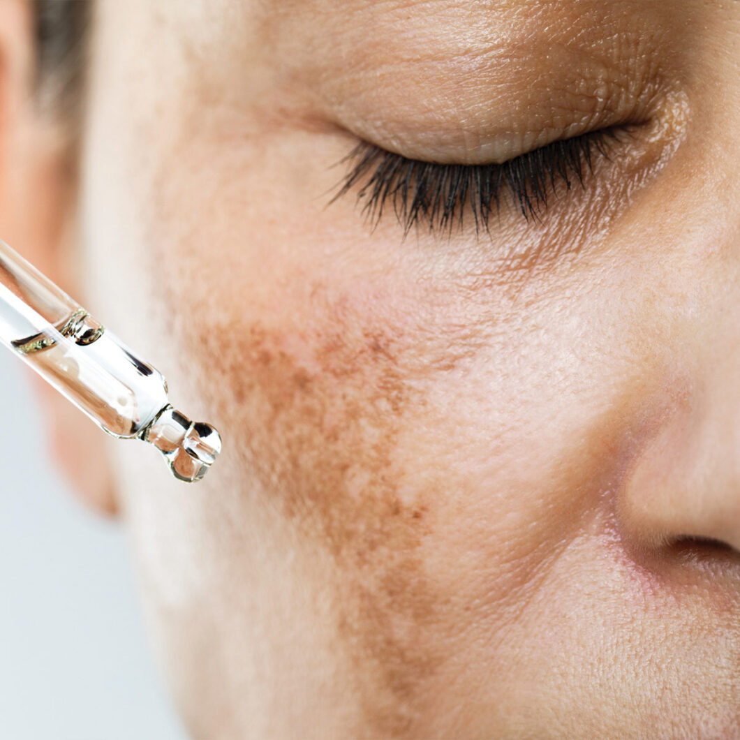 Photoaging - HealthScope® Magazine