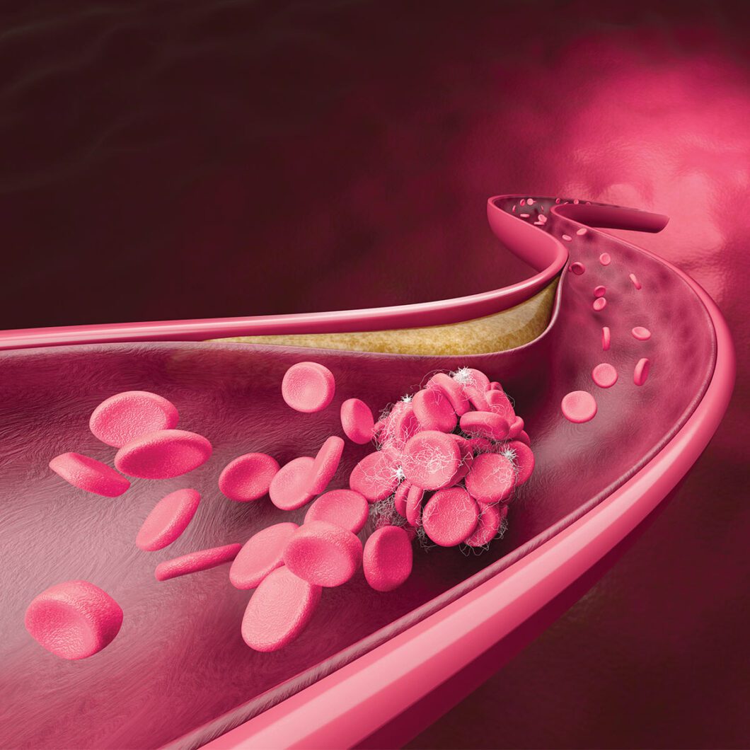 Venous Compression Syndromes - HealthScope® Magazine