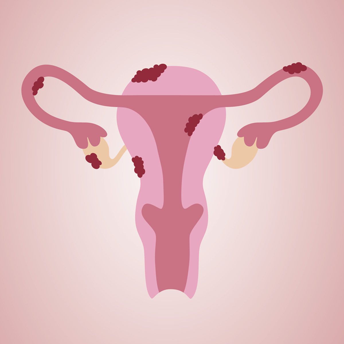 Endometriosis - HealthScope® Magazine